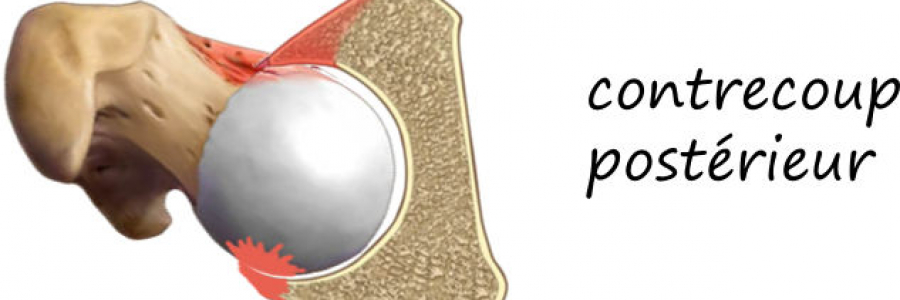 Conflit de Hanche – Le Centre Chirurgical De L'ARTHROSE