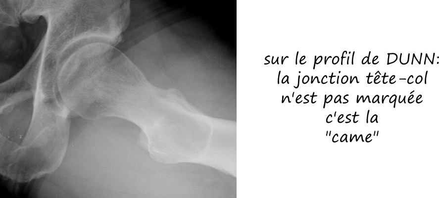 Conflit de Hanche – Le Centre Chirurgical De L'ARTHROSE